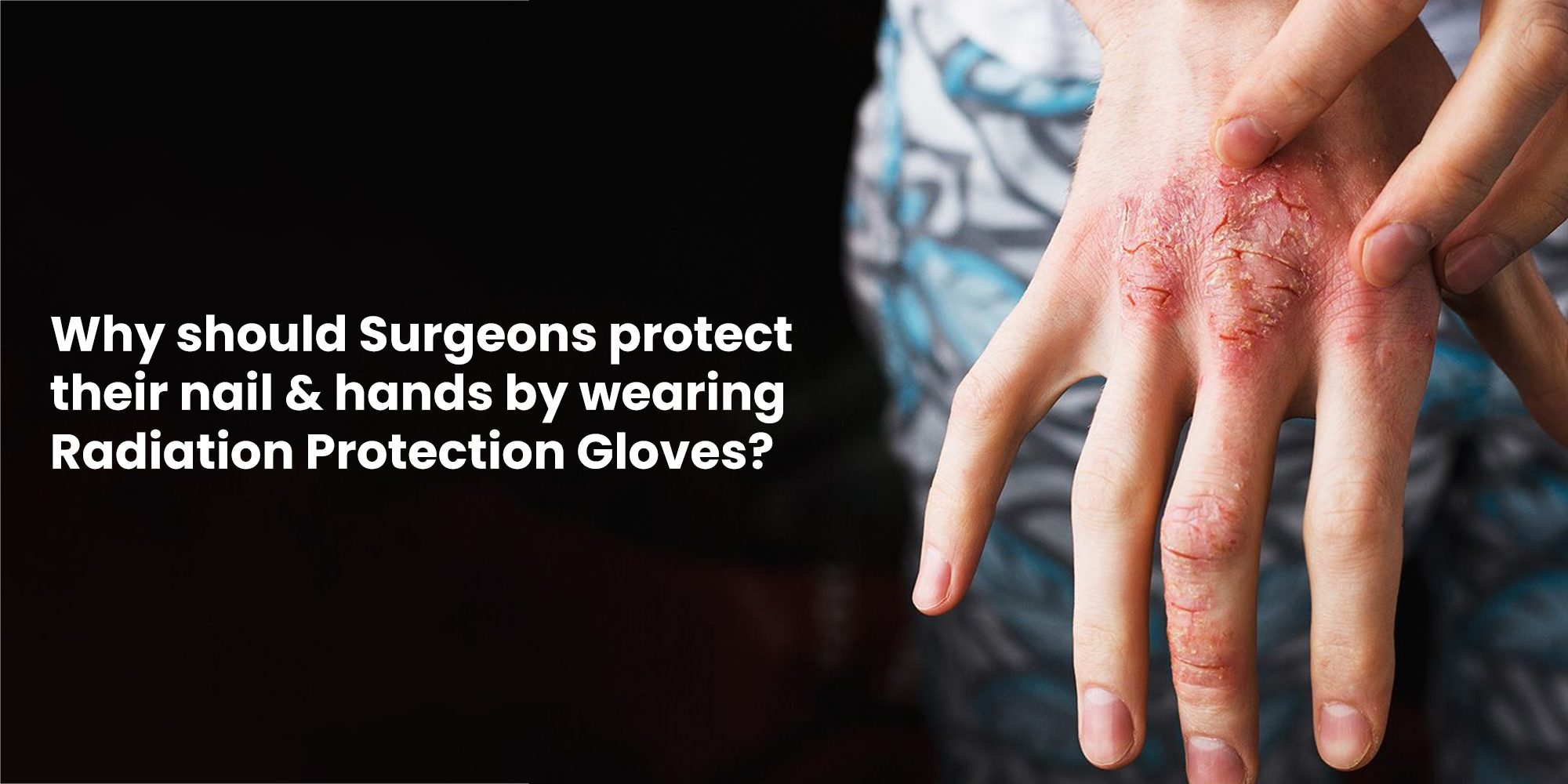 Radiation Burns From Fluoroscopy